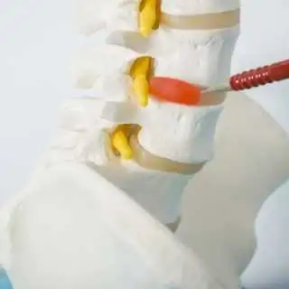 Back Pain Causes: Pinched Nerve or Degenerative Disc Disease | CMW